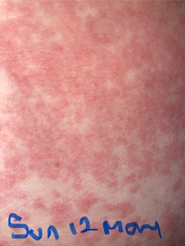 Skin Rash - Stroke Association Online Community